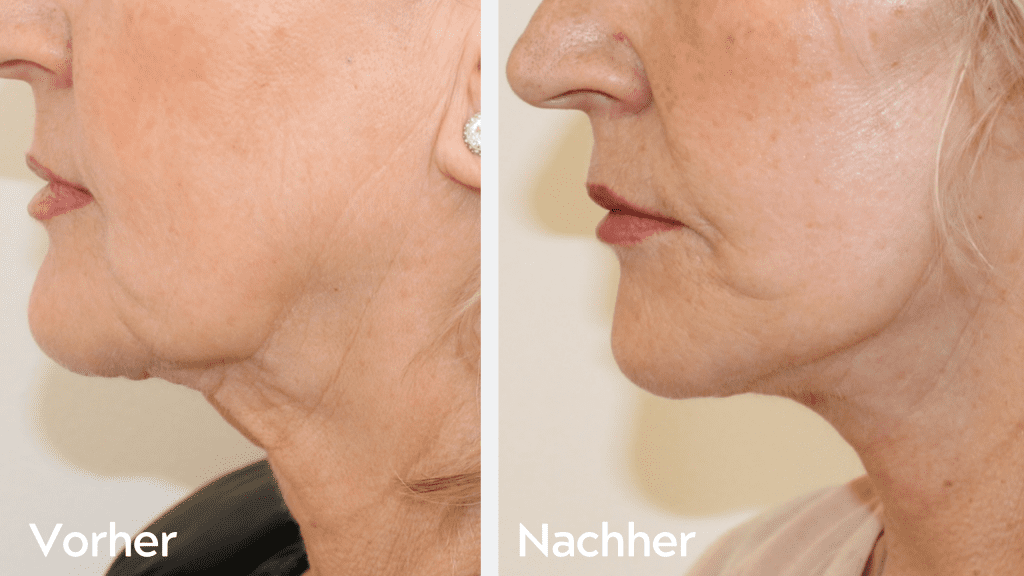One Stitch Facelift | Dr. Daniela Rieder in Wien und Krems